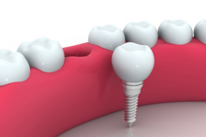 Why Choose Dental Implants? | Edward Gottesman, DDS, Manhattan