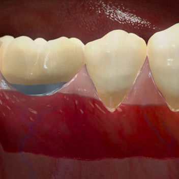 Cell-based Therapy to Regenerate Gum Tissue - Manhattan Periodontist Dr ...